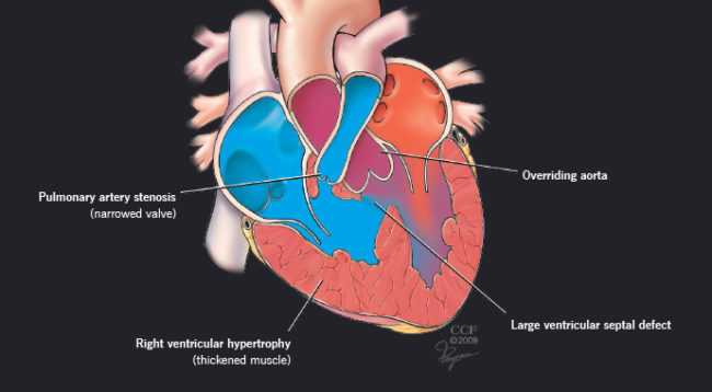 What is the Tetralogy of Fallot? | 8 Things You Should Know About TOF ...